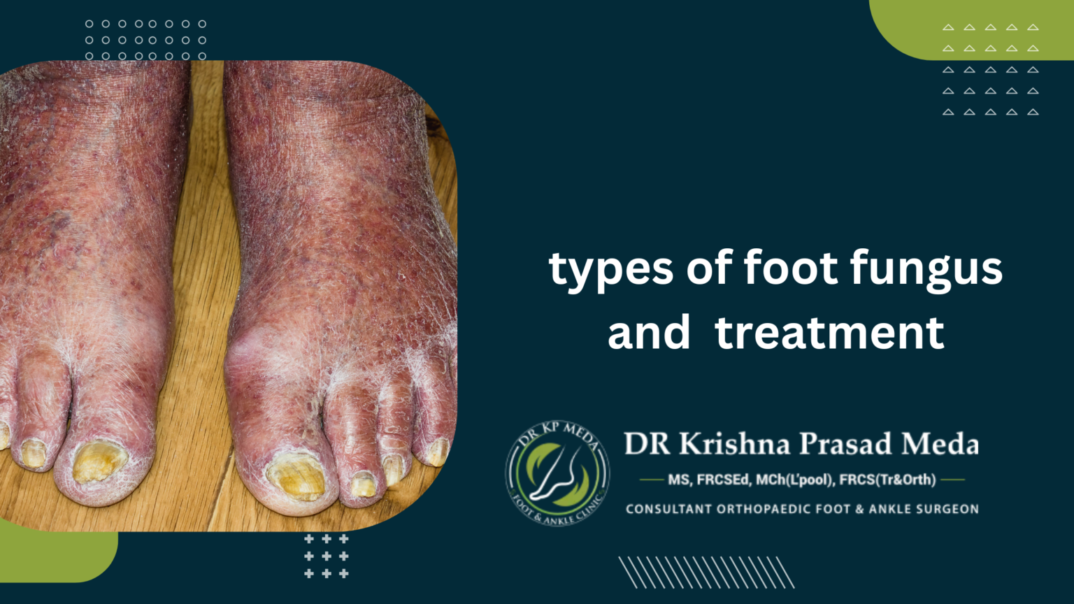 Types of foot fungus - Dr KP Meda