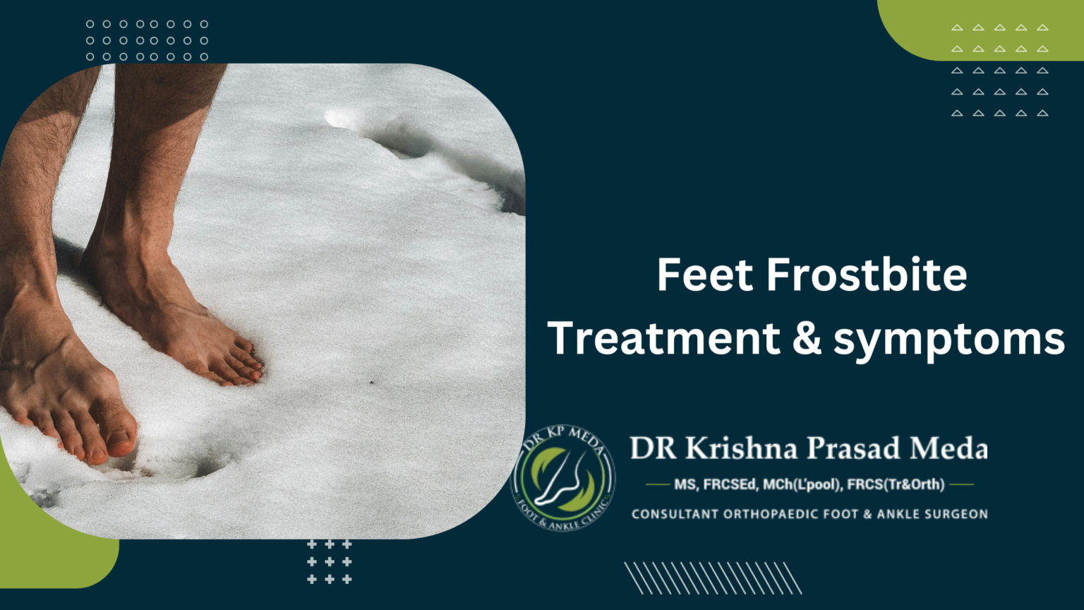 feet frostbite treatment